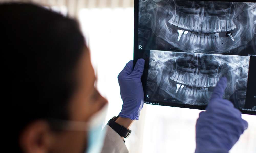Does bone grow back after an Apicoectomy? - Pristine Oral Surgery