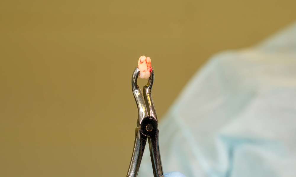 Why do experts now say not to remove your wisdom teeth? - Pristine Oral ...